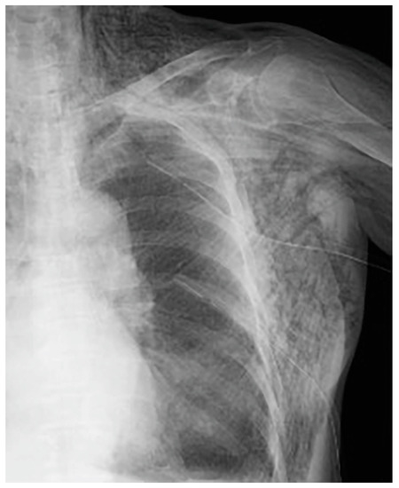 A Case of Pneumothorax Ex Vacuo Associated with COVID-19