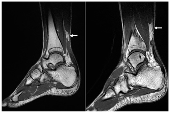 Taekwondo Athlete’s Bilateral Achilles Tendon Rupture: A Case Report