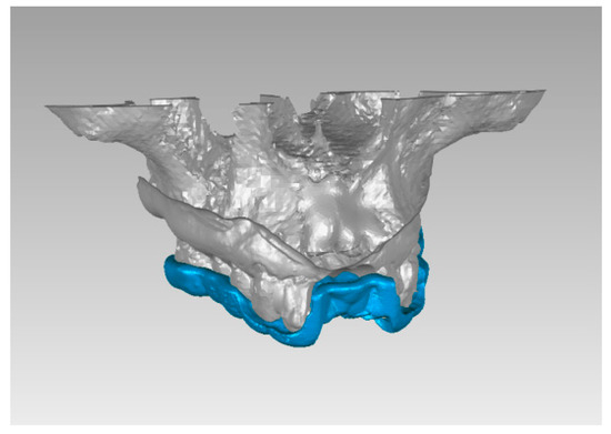 Accuracy of Computer-Guided Implantology with Pilot Drill Surgical ...