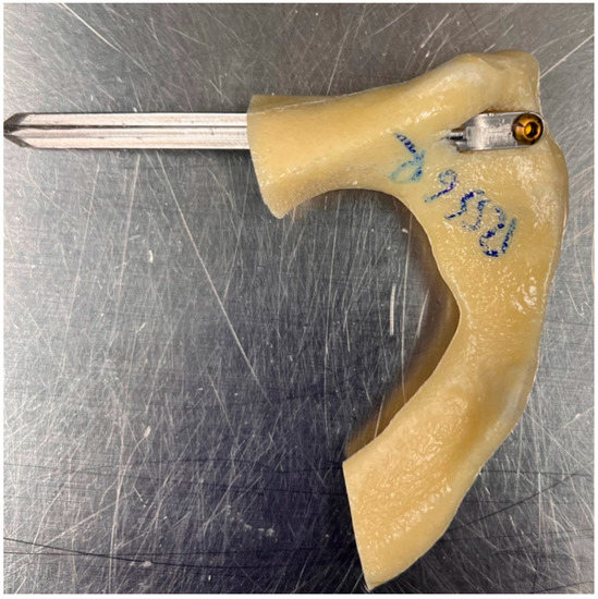 A Novel Implant for Superior Pubic Ramus Fracture Fixation—Development ...