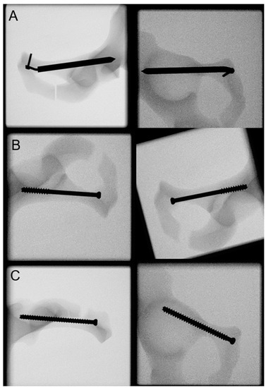 A Novel Implant for Superior Pubic Ramus Fracture Fixation—Development ...