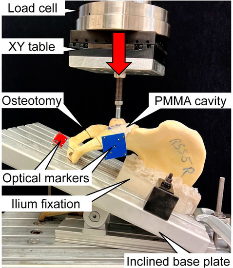A Novel Implant for Superior Pubic Ramus Fracture Fixation—Development ...