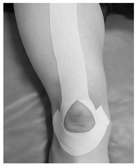 Medicina | Free Full-Text | Effect of Adding Kinesio Taping to Exercise ...