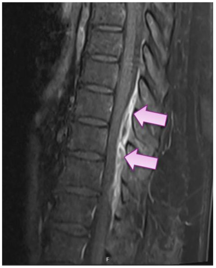 Epidural Abscesses as a Complication of Interleukin-6 Inhibitor and ...
