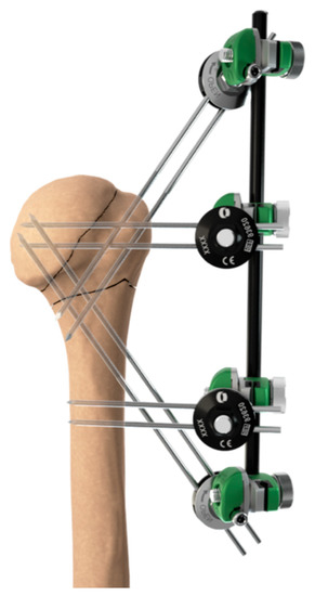 Humeral Head Three-Part Posterior Fracture-Dislocation Reduced through ...