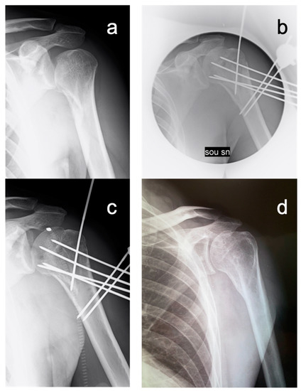 Medicina | Free Full-Text | Humeral Head Three-Part Posterior Fracture ...