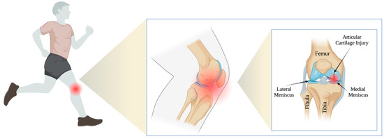 Hyalofast Cartilage Repair Surgery with a Full Load-Bearing ...