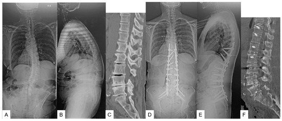 Medicina | Free Full-Text | Comparison of C-Arm-Free Oblique Lumbar ...