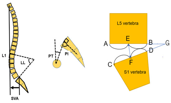 Medicina | Free Full-Text | Comparison of C-Arm-Free Oblique Lumbar Interbody Fusion L5-S1 ...