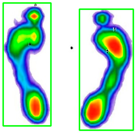 Labeling of Baropodometric Analysis Data Using Computer Vision ...