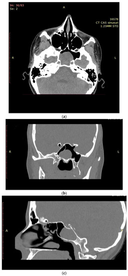Management of Capillary Hemangioma of the Sphenoid Sinus
