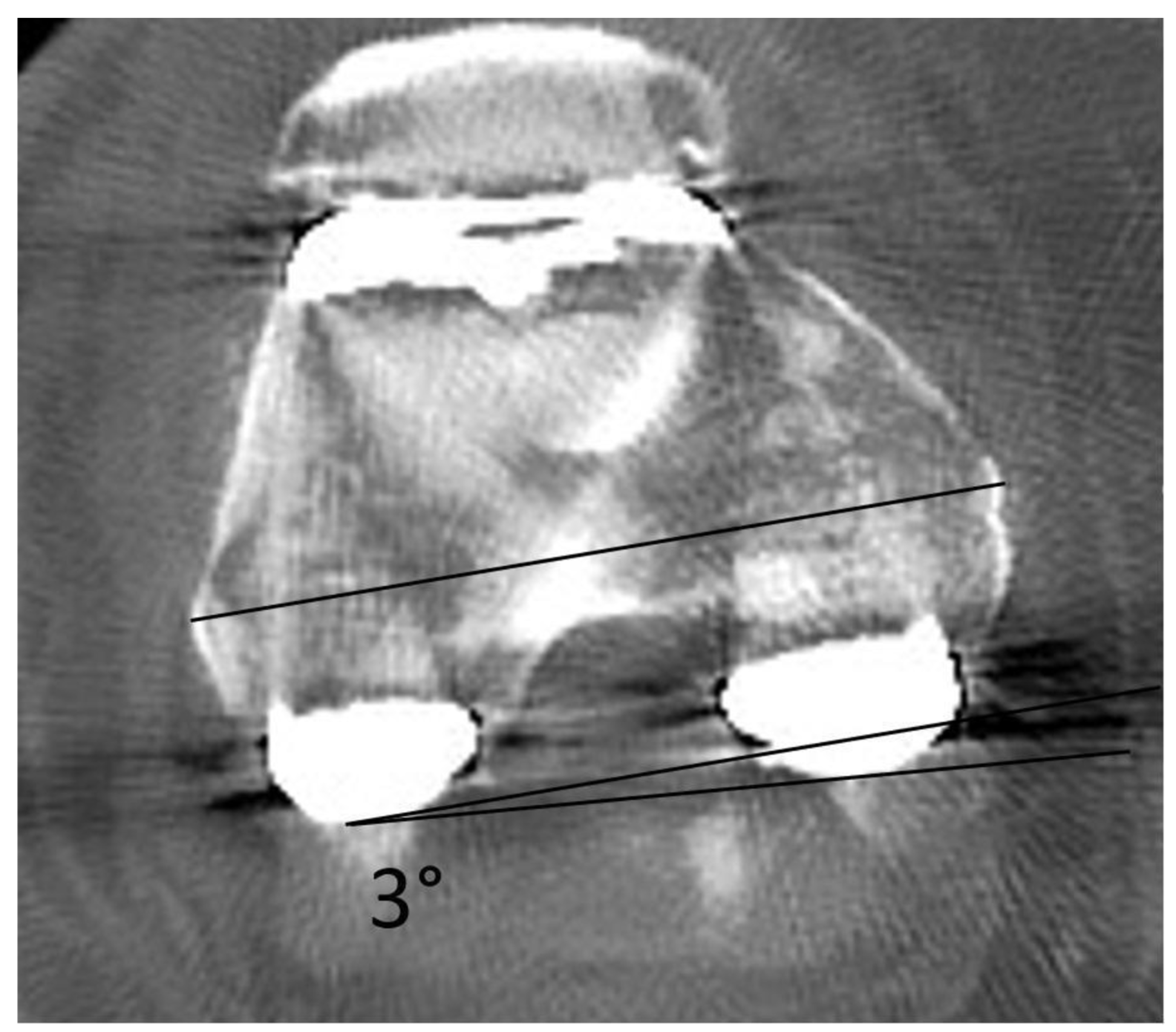Comparison of Femoral Component Rotation between Robotic-Assisted vs ...