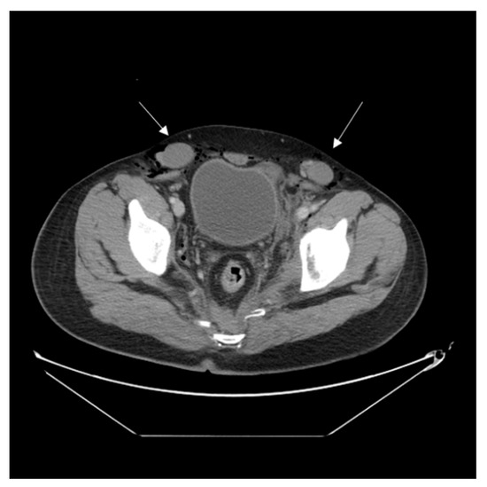 A Rare and Easily Overlooked Case of Bilateral Traumatic Testicular ...