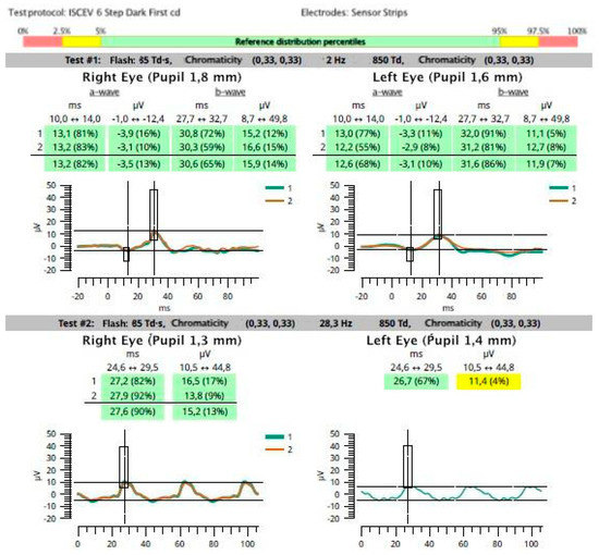 Medicina | Free Full-Text | Age-Related Macular or Retinal Degeneration?
