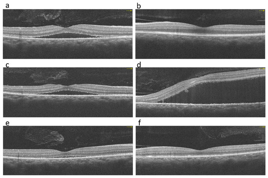 Medicina | Free Full-Text | Diagnosis and Treatment of Central Serous ...