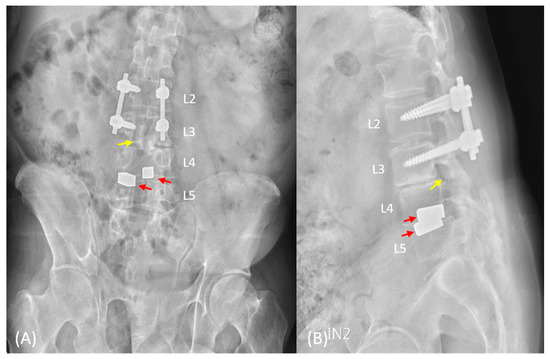 Complete Intradural Interbody Cage Migration in Lumbar Spine Surgery: A ...