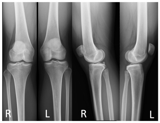 Reconstruction of High-Grade Trochlea Dysplasia in a Young Female with ...