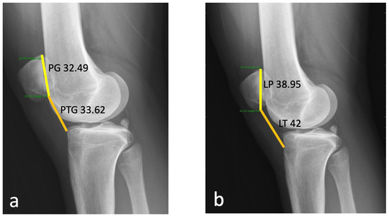 Reconstruction of High-Grade Trochlea Dysplasia in a Young Female with Recurrent Patella ...