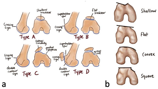 Reconstruction of High-Grade Trochlea Dysplasia in a Young Female with Recurrent Patella ...