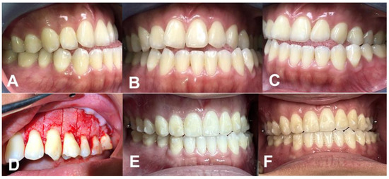 Harnessing the Power of PAOO and Invisalign: An Interdisciplinary ...