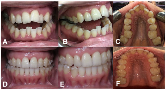 Harnessing the Power of PAOO and Invisalign: An Interdisciplinary ...