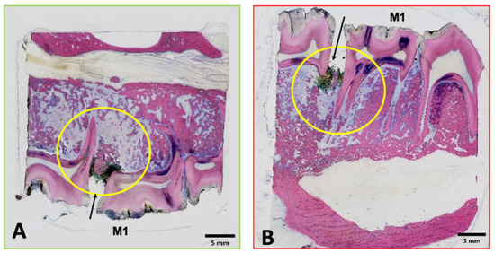 Chronic Periodontal Infection and Not Iatrogenic Interference Is the ...