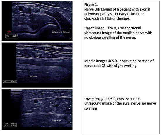 Nerve Ultrasound of Peripheral Nerves in Patients Treated with Immune ...
