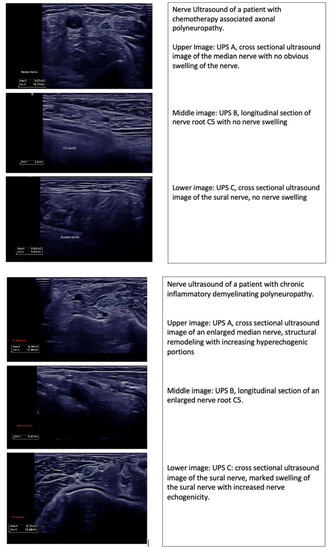 Nerve Ultrasound of Peripheral Nerves in Patients Treated with Immune ...