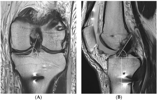Femoral Tunnel Geometry and Graft Inclination Angles in Anterior ...
