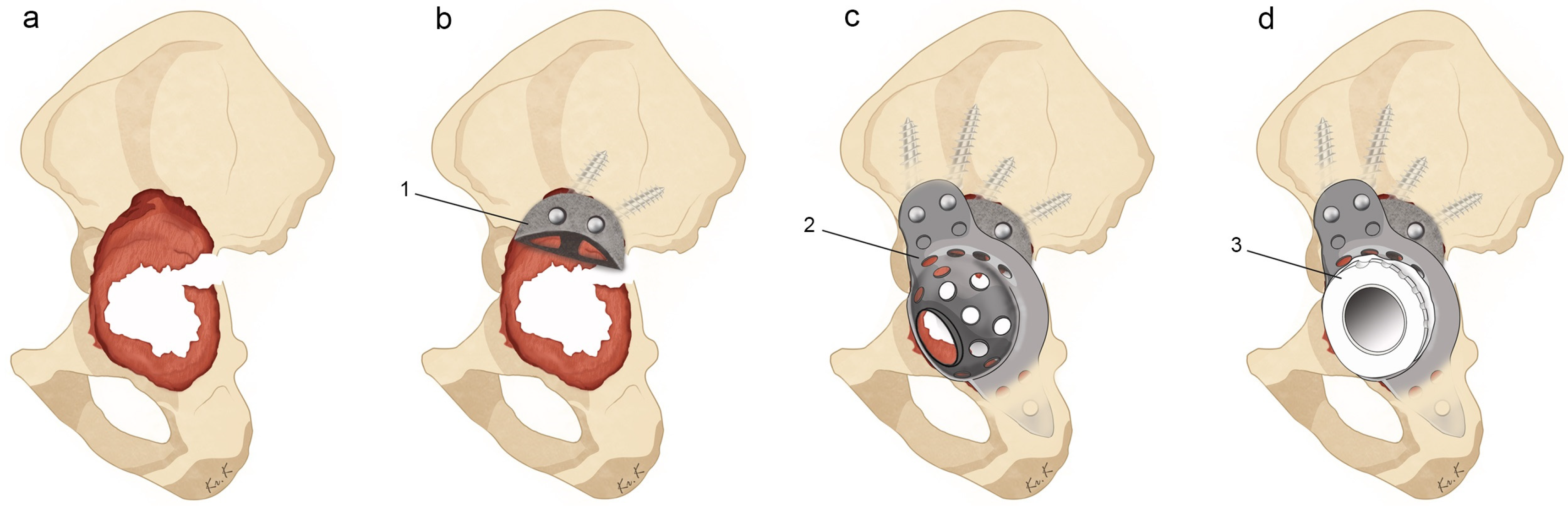 Acetabular Reconstruction Classification Of Bone Defe