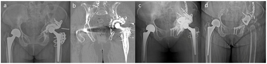 Revision Total Hip Arthroplasty Utilizing an Acetabular Reinforcement ...