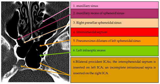 Anatomical Variants of Internal Carotid Artery—Results from a ...