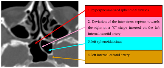 Medicina | Free Full-Text | Anatomical Variants of Internal Carotid ...