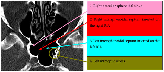 Anatomical Variants of Internal Carotid Artery—Results from a ...