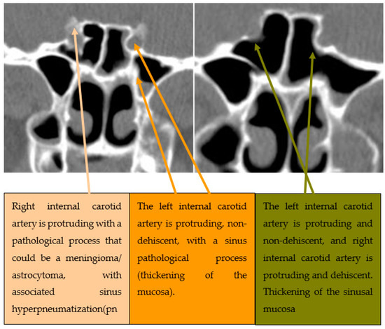 Anatomical Variants of Internal Carotid Artery—Results from a Retrospective Study