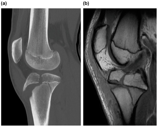 Type V Tibial Tubercle Avulsion Fracture with Suspected Complication of ...