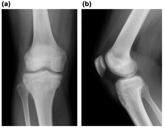 Type V Tibial Tubercle Avulsion Fracture with Suspected Complication of ...