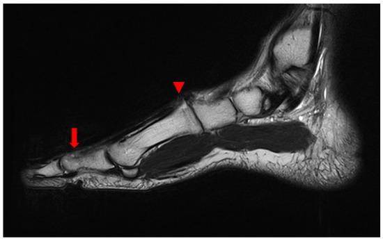 A Neglected Extensor Hallucis Longus Tendon Rupture Caused by Arthritic ...