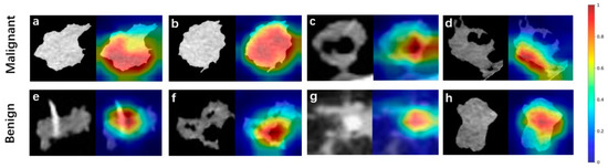 Deep-Learning Model of ResNet Combined with CBAM for Malignant–Benign Pulmonary Nodules ...