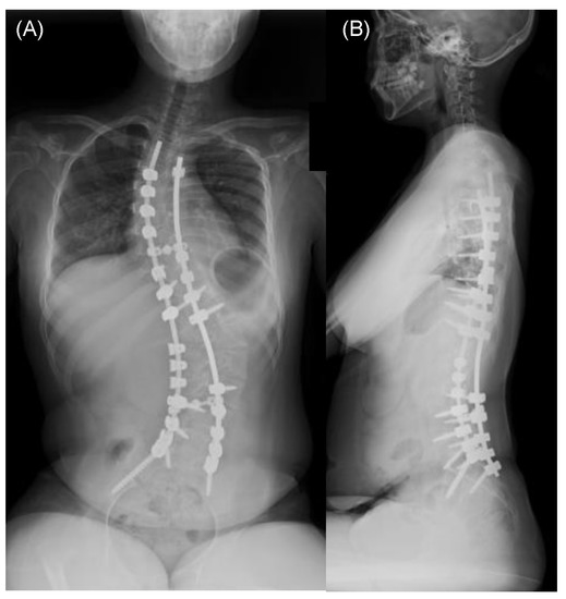 Posterior Spinal Fusion Surgery for Neuromuscular Disease Patients with ...