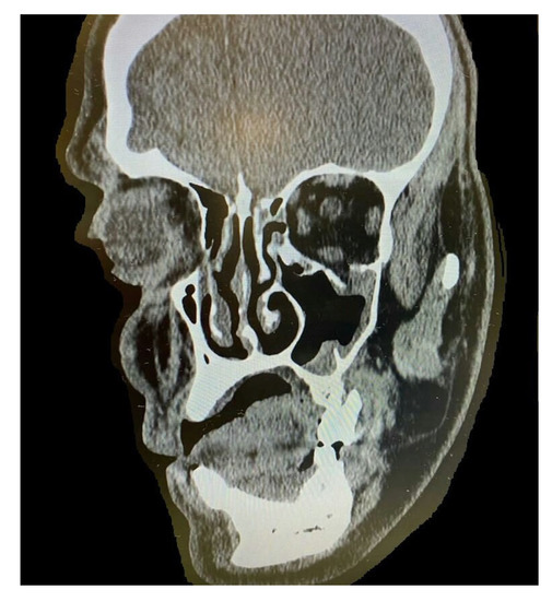 Ocular Findings in Patients with Orbital Fractures: A 1-Year ...