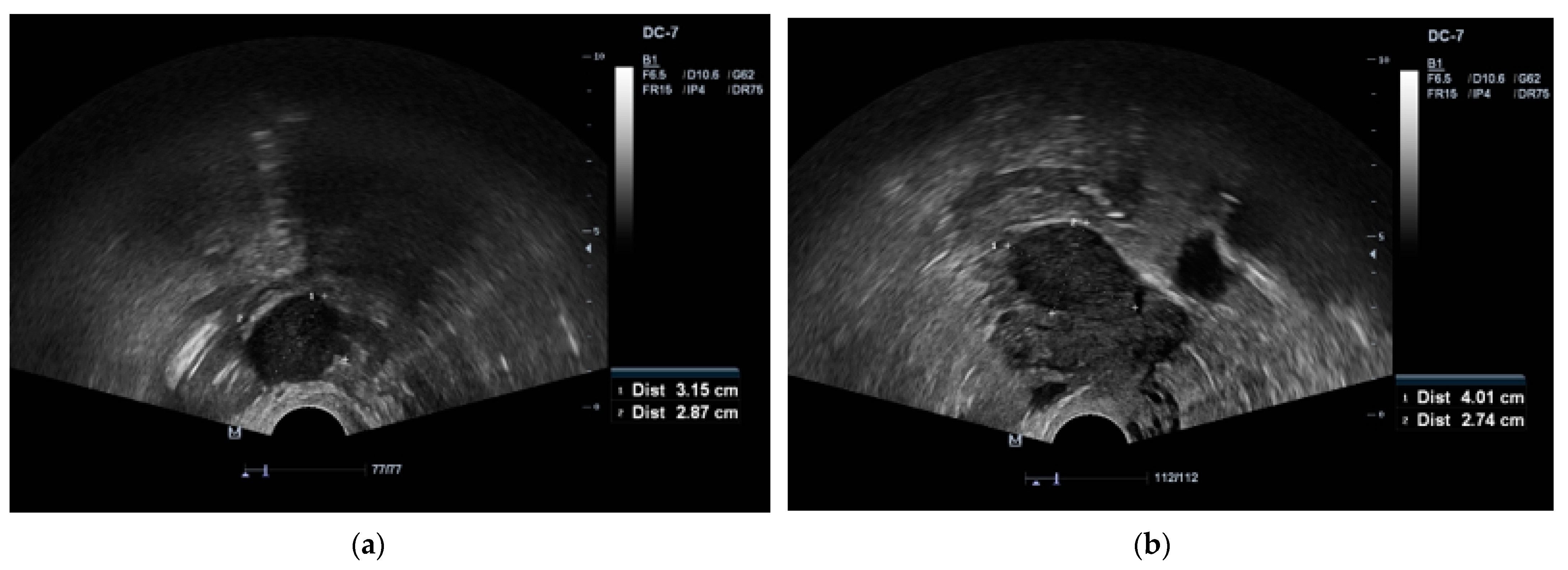 Ovarian Leydig Cell Tumor And Ovarian Hyperthecosis In A Postmenopausal