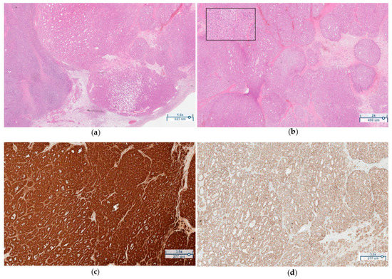 Ovarian Leydig Cell Tumor and Ovarian Hyperthecosis in a Postmenopausal ...