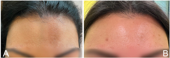 Adult-Onset Linear Morphea (en coupe de sabre) of the Face Successfully ...