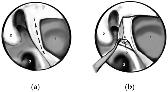 Endoscopic Sphenopalatine Artery Cauterization in the Management of ...