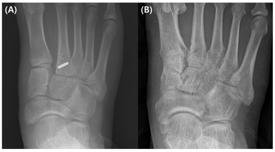 Various Flexible Fixation Techniques Using Suture Button for ...