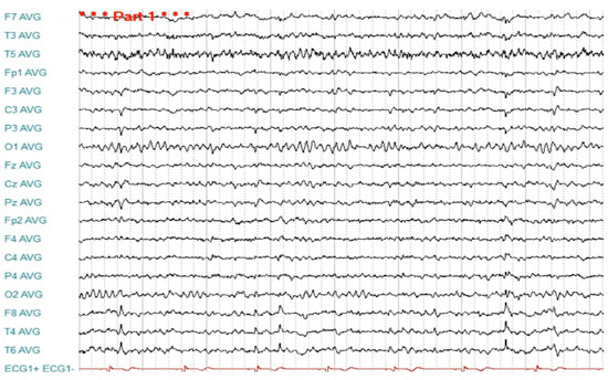 GAD65 Antibody-Associated Epilepsy