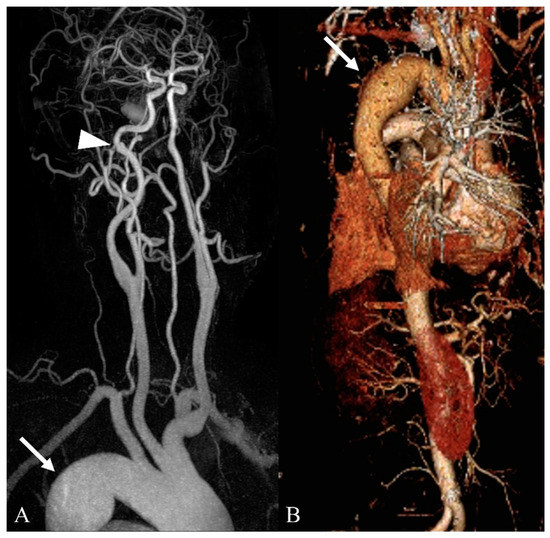 Prevalence and Clinical Implications of Incidental Aortic Arch ...