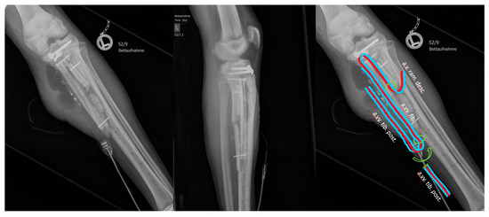 Medicina | Free Full-Text | Simultaneous Free Fibula and Anterolateral ...