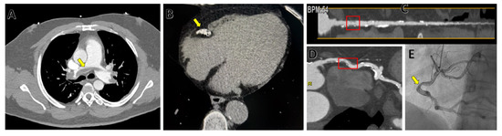 Medicina | Free Full-Text | Multimodality Cardiac Imaging in COVID-19 Infection